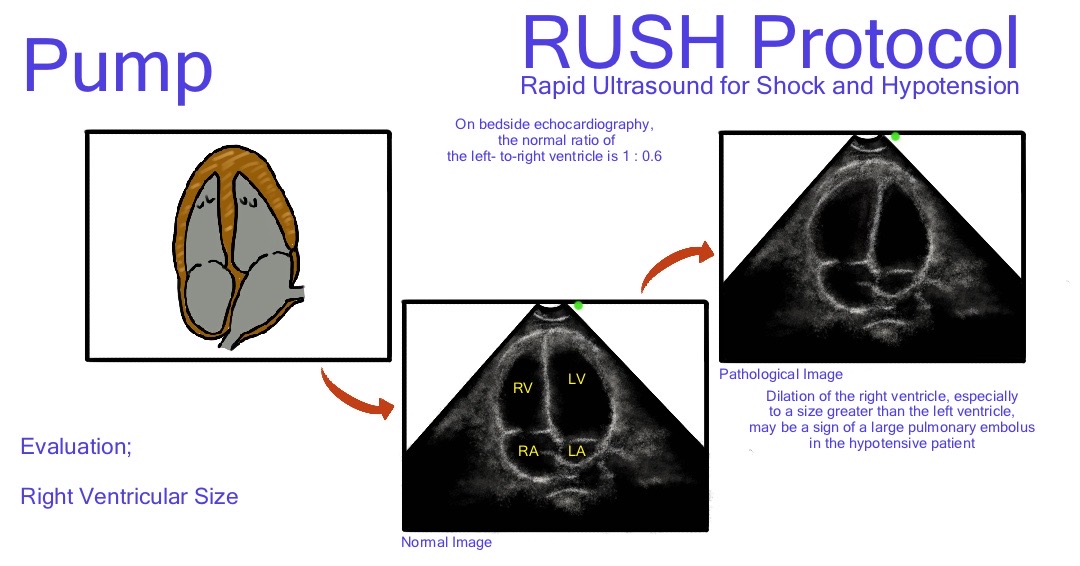 Rapid Ultrasound for Shock and Hypotension (RUSH) Protocol US Imaging ...