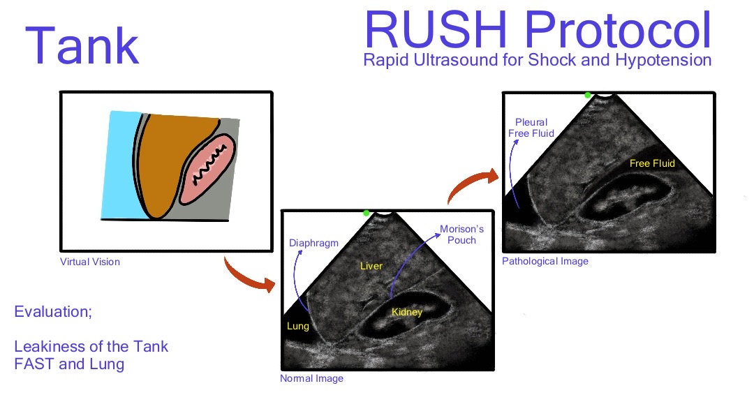 Rapid Ultrasound for Shock and Hypotension (RUSH) Protocol US Imaging ...