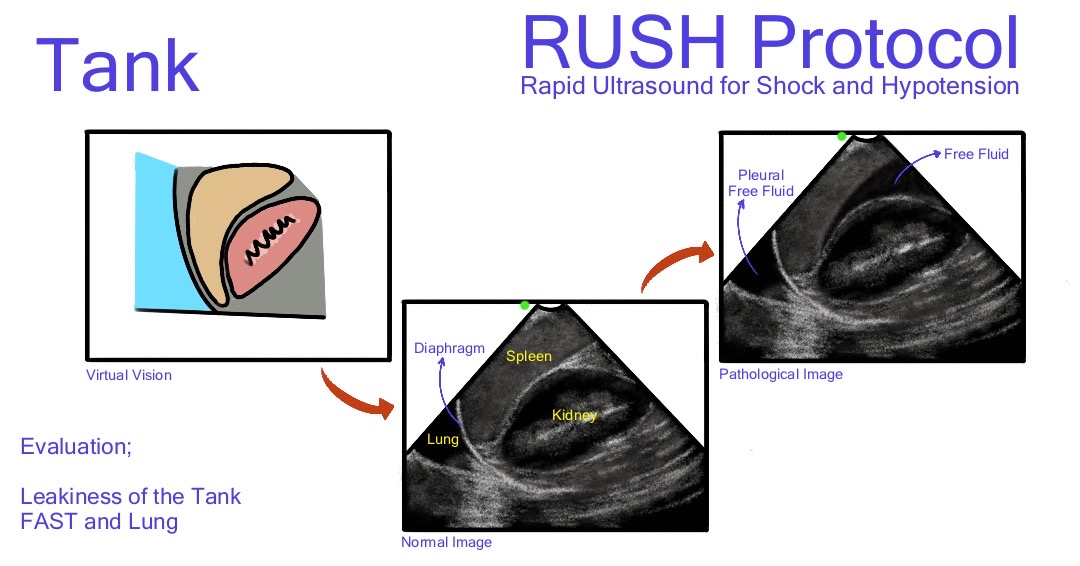 Rapid Ultrasound for Shock and Hypotension (RUSH) Protocol US Imaging ...