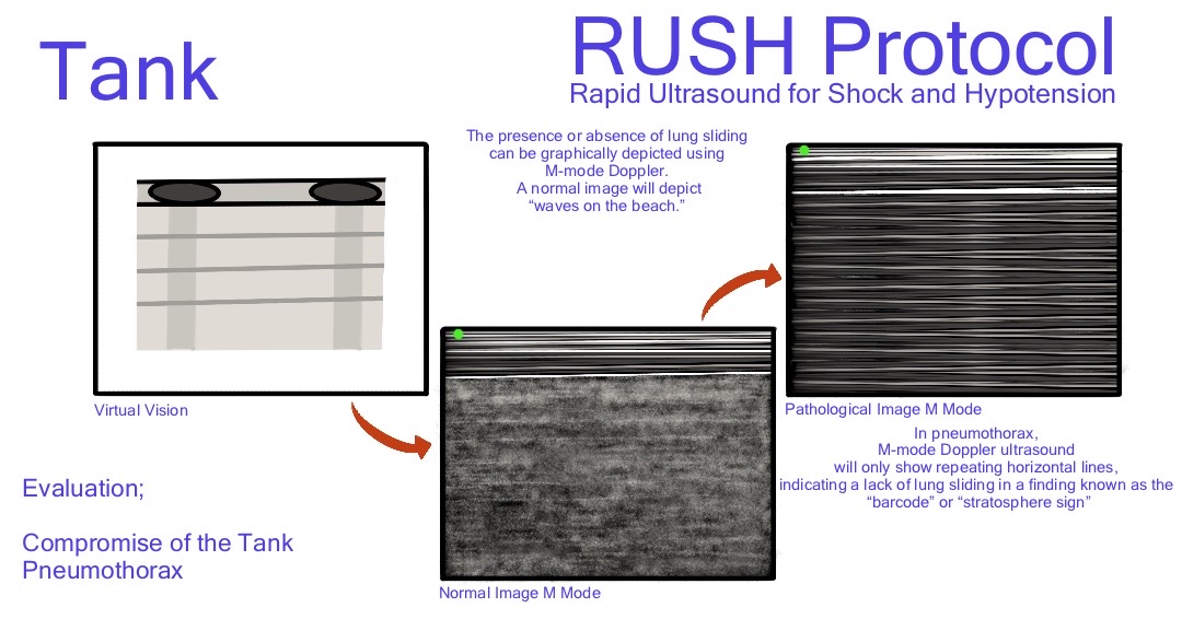 Rapid Ultrasound for Shock and Hypotension (RUSH) Protocol US Imaging ...