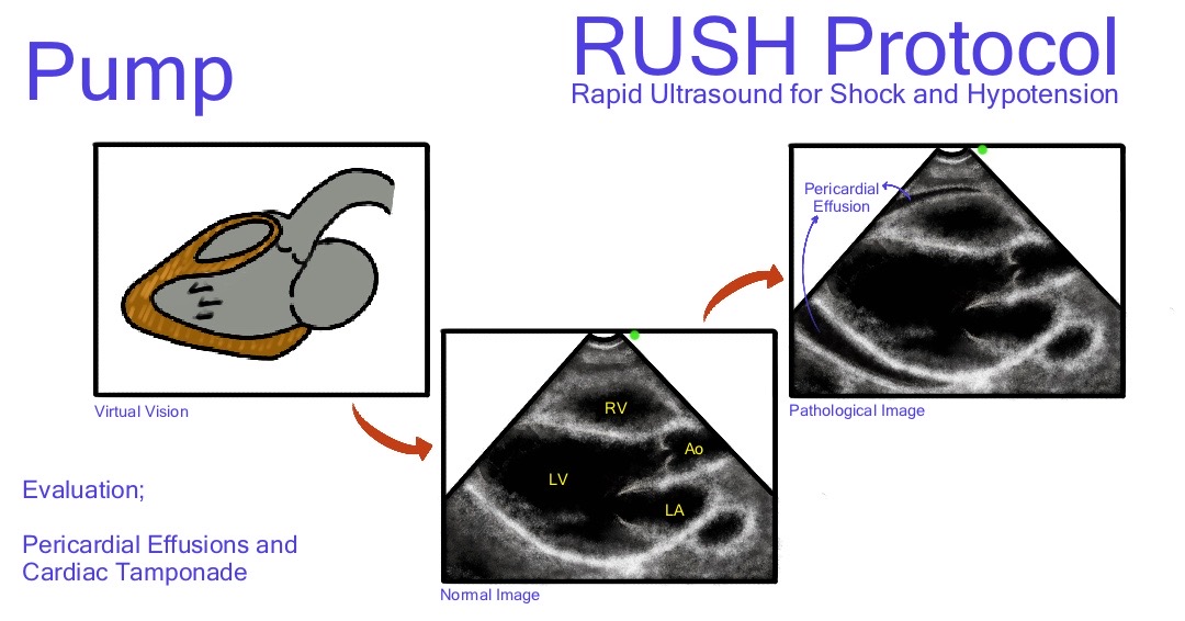Rapid Ultrasound for Shock and Hypotension (RUSH) Protocol US Imaging ...