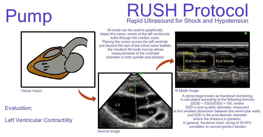 Rapid Ultrasound for Shock and Hypotension (RUSH) Protocol US Imaging ...