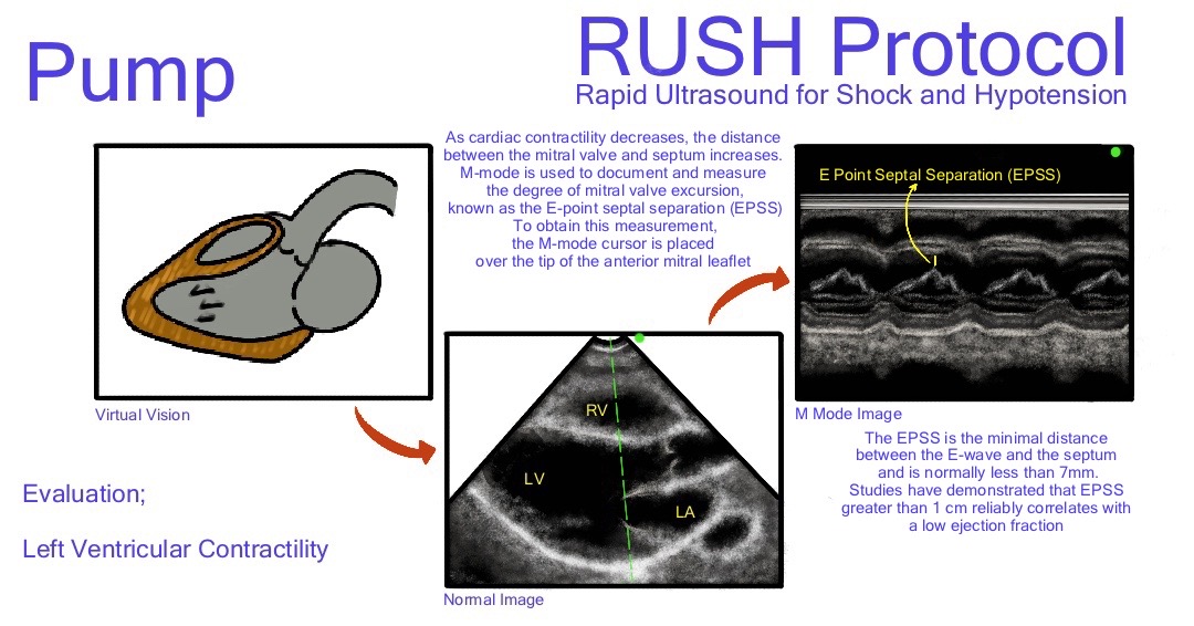 Rapid Ultrasound for Shock and Hypotension (RUSH) Protocol US Imaging ...